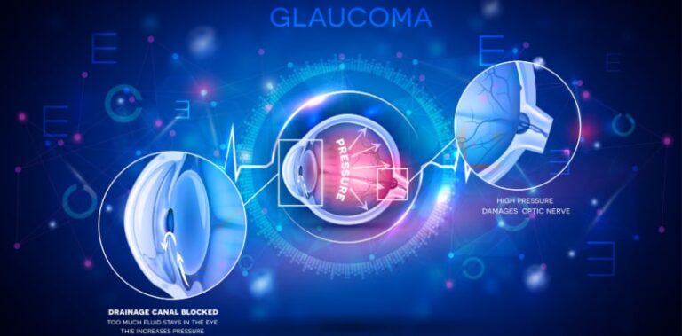 Glaucoma – causes, symptoms, and treatment - Donovan Smith Opticians