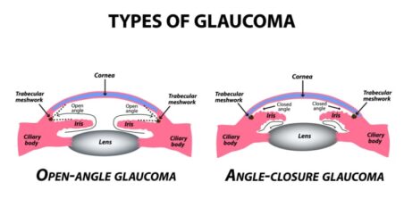 Glaucoma – causes, symptoms, and treatment - Donovan Smith Opticians